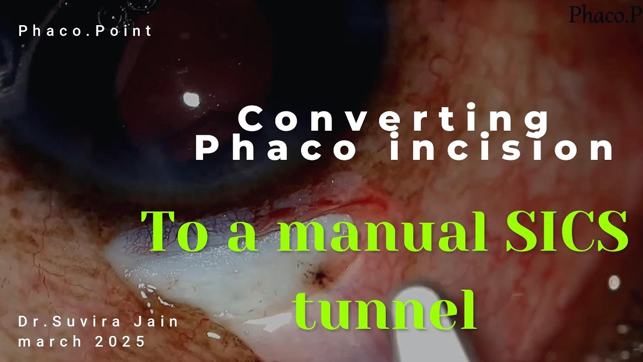 Converting a Phaco Incision to a Manual S.I.C.S Tunnel - The Finer ...