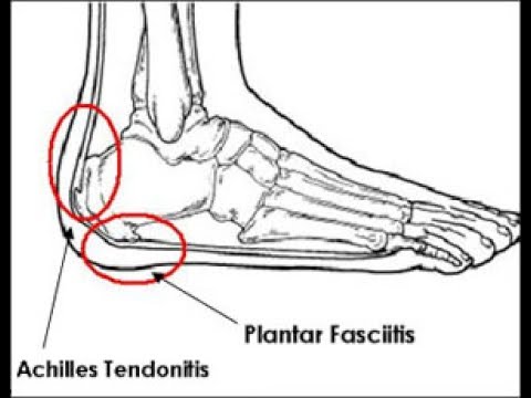 Confusing Bursitis with Plantar Fasciitis - YouTube