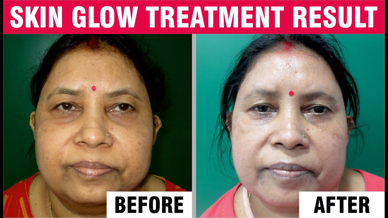 Best Clinic for Skin Glow treatments | Professional Skin Glow ...