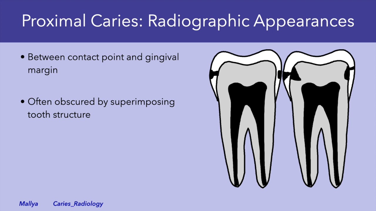 Radiologic Detection And Evaluation Of Caries Youtube