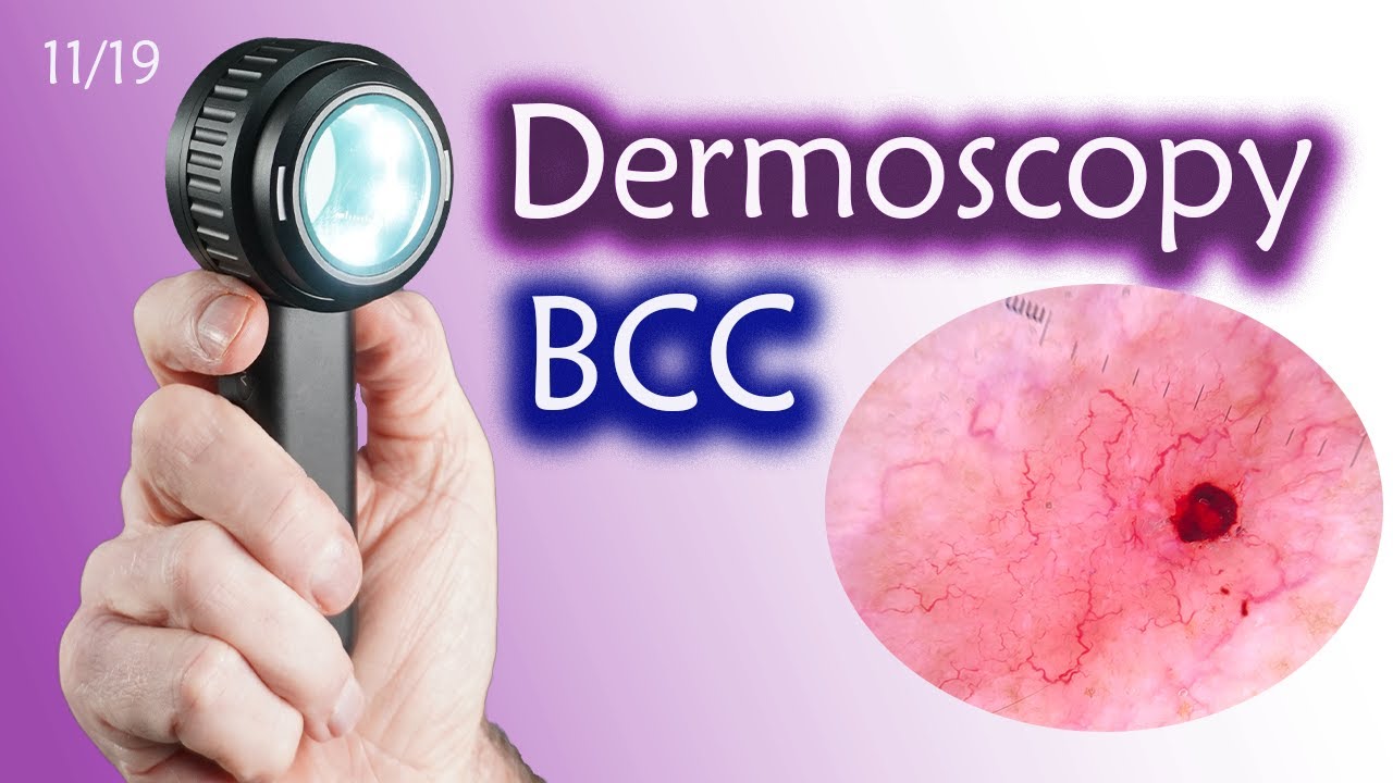 The Dermoscopy of Basal Cell Cancers [BCC's] - YouTube