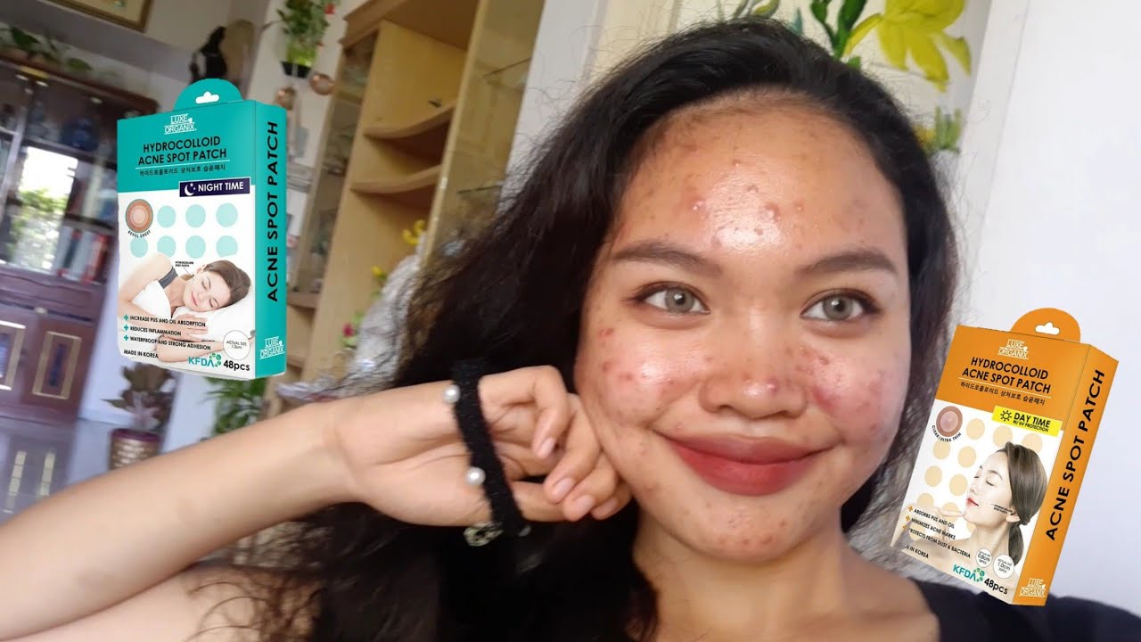 I tried Stícker for Ácne!!! Astig naman! - YouTube