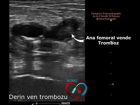 Ultrason görüntüsü, Derin ven trombzu(DVT)