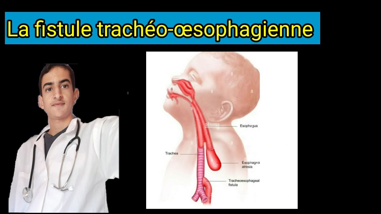 La fistule trachéo-œsophagienne - YouTube