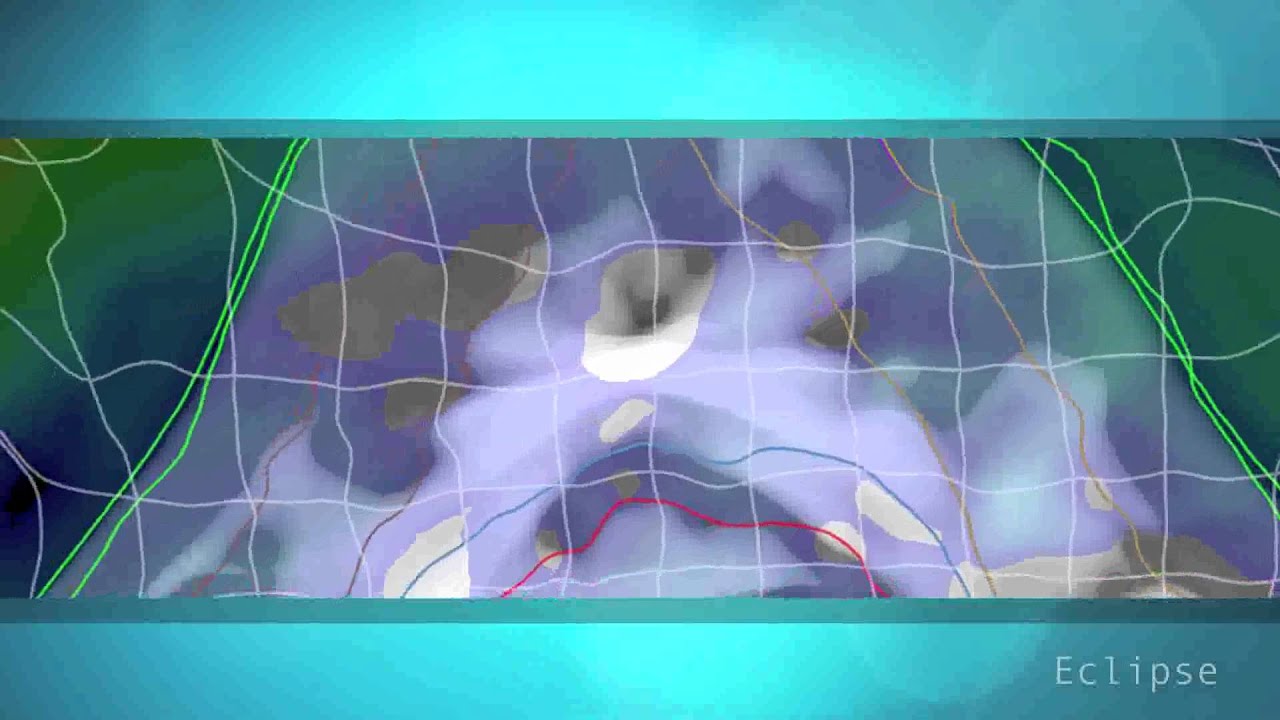 Varian Eclipse Product - YouTube