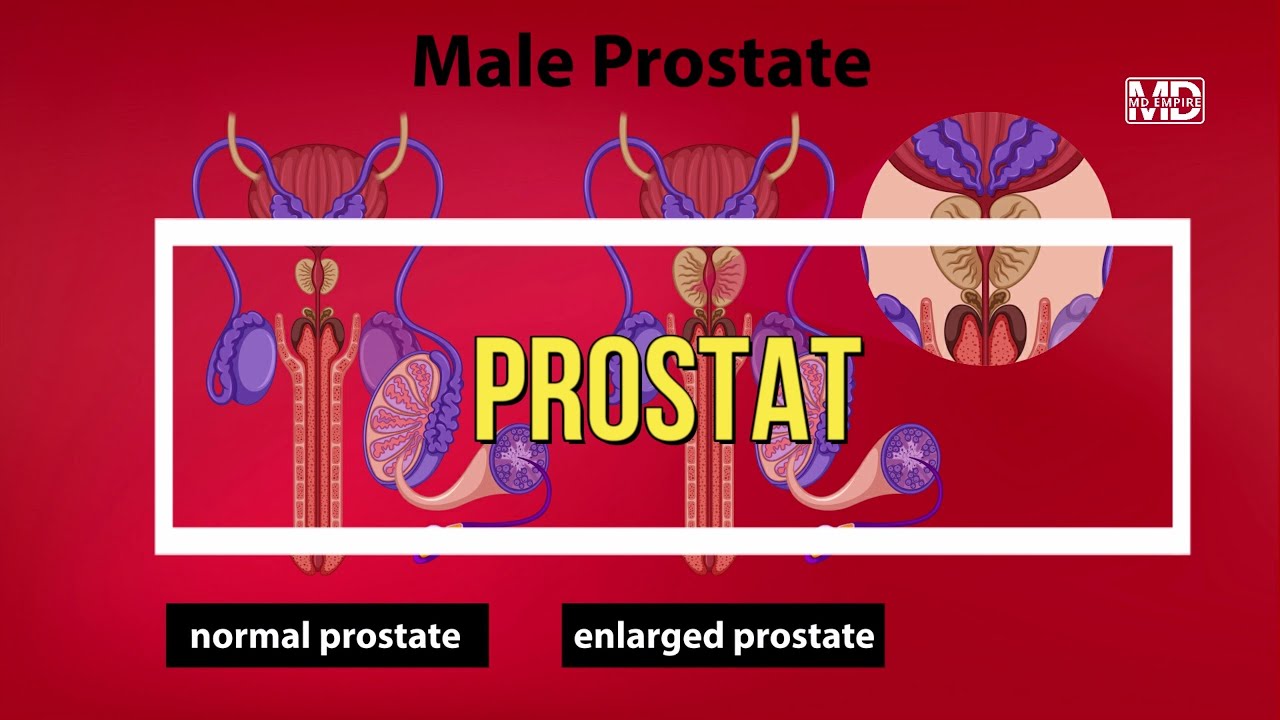 Masalah Bengkak Prostat & Kencing Tak Lawas - YouTube
