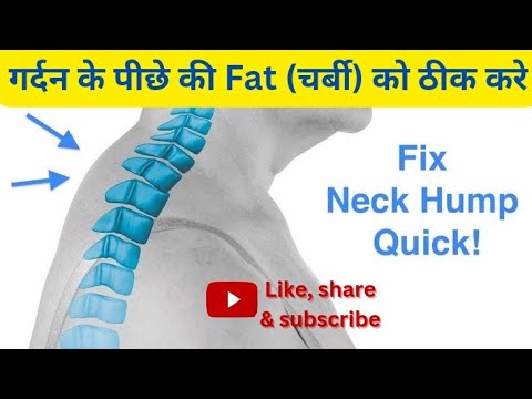 Neck Hump/ Buffalo hump best exercises, Precautions - YouTube
