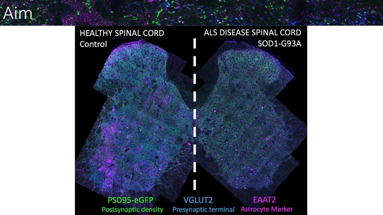Dr Matthew Broadhead - Synaptic Changes in ALS - MND/ALS Symposium 2020 ...