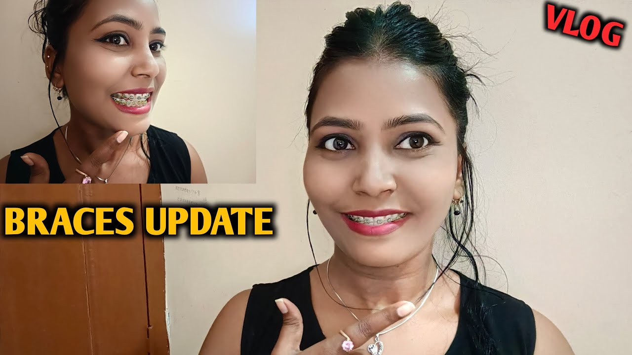 Braces Update || Braces Journey || Nd Family Vlogs - YouTube
