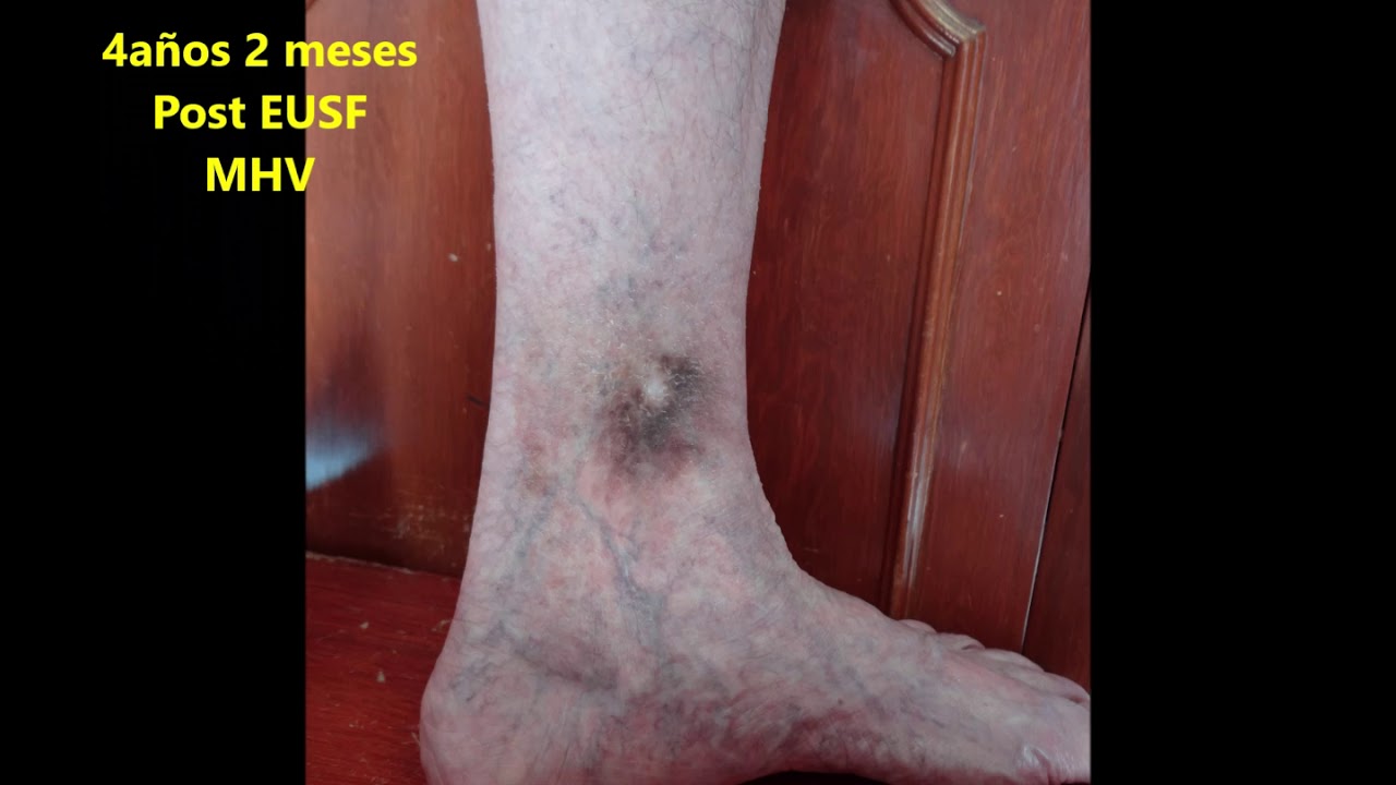 Evolucion de la Dermatolipoesclerosis DLE - YouTube