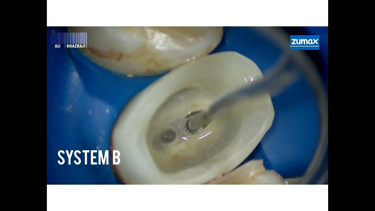 save a destructed premolar - DME + Pre endo build up + endo + Resto in ...