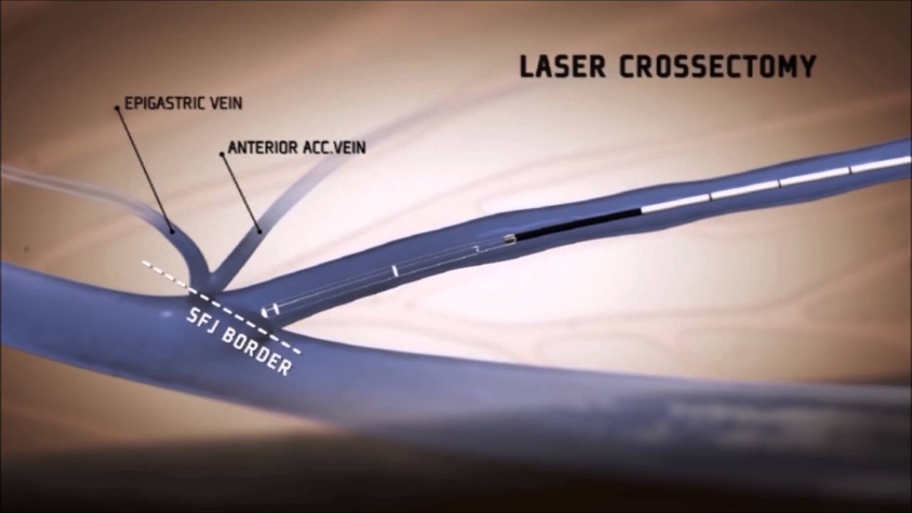 laser crossectomy dr Dragić - YouTube