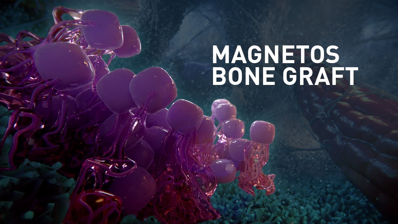 How MagnetOs can help you achieve a more predictable fusion | Medical ...