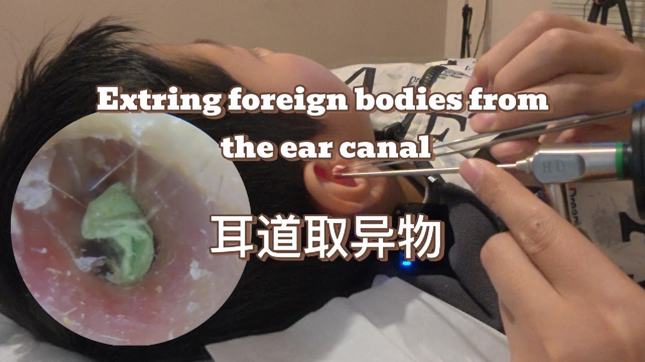 Extring foreign bodies from the ear canal 取耳道异物 - YouTube
