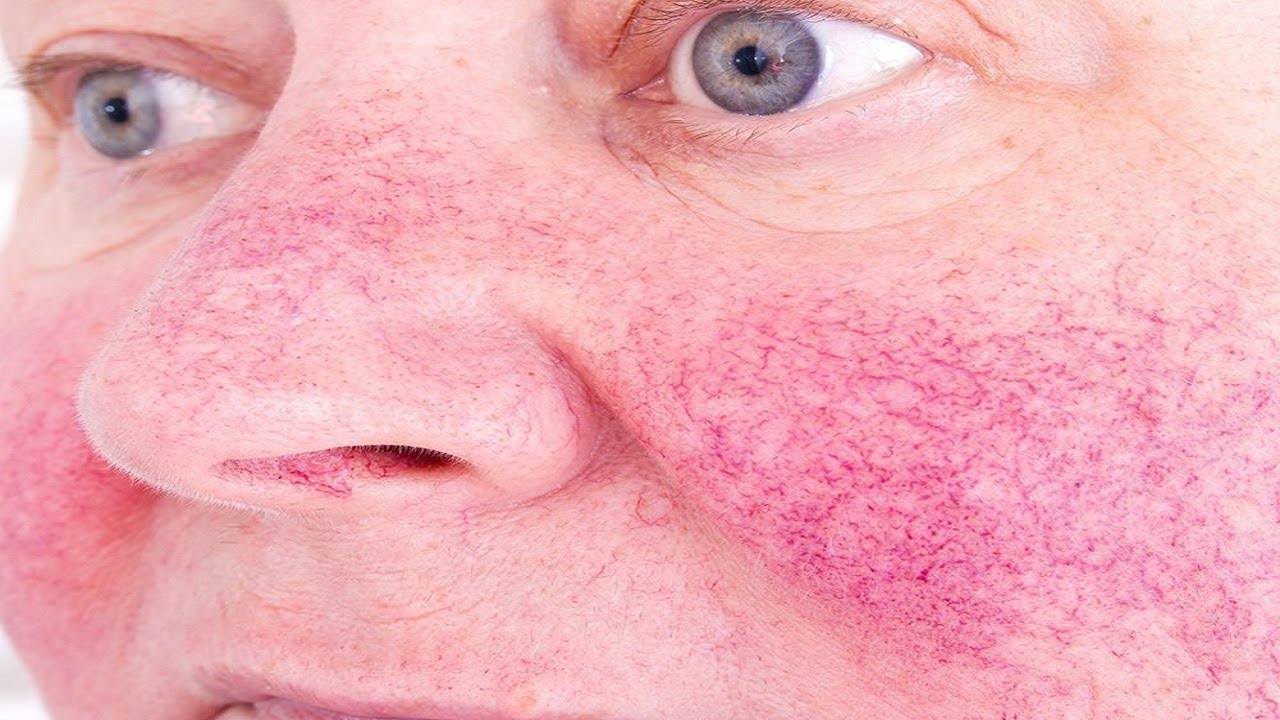 How to Get Rid of Rosacea Permanently - 5 Remedies for Reduce Redness ...