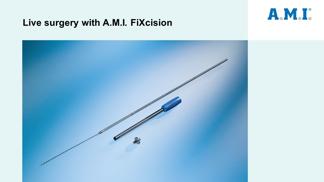 Live surgery with A.M.I. FiXcision - YouTube