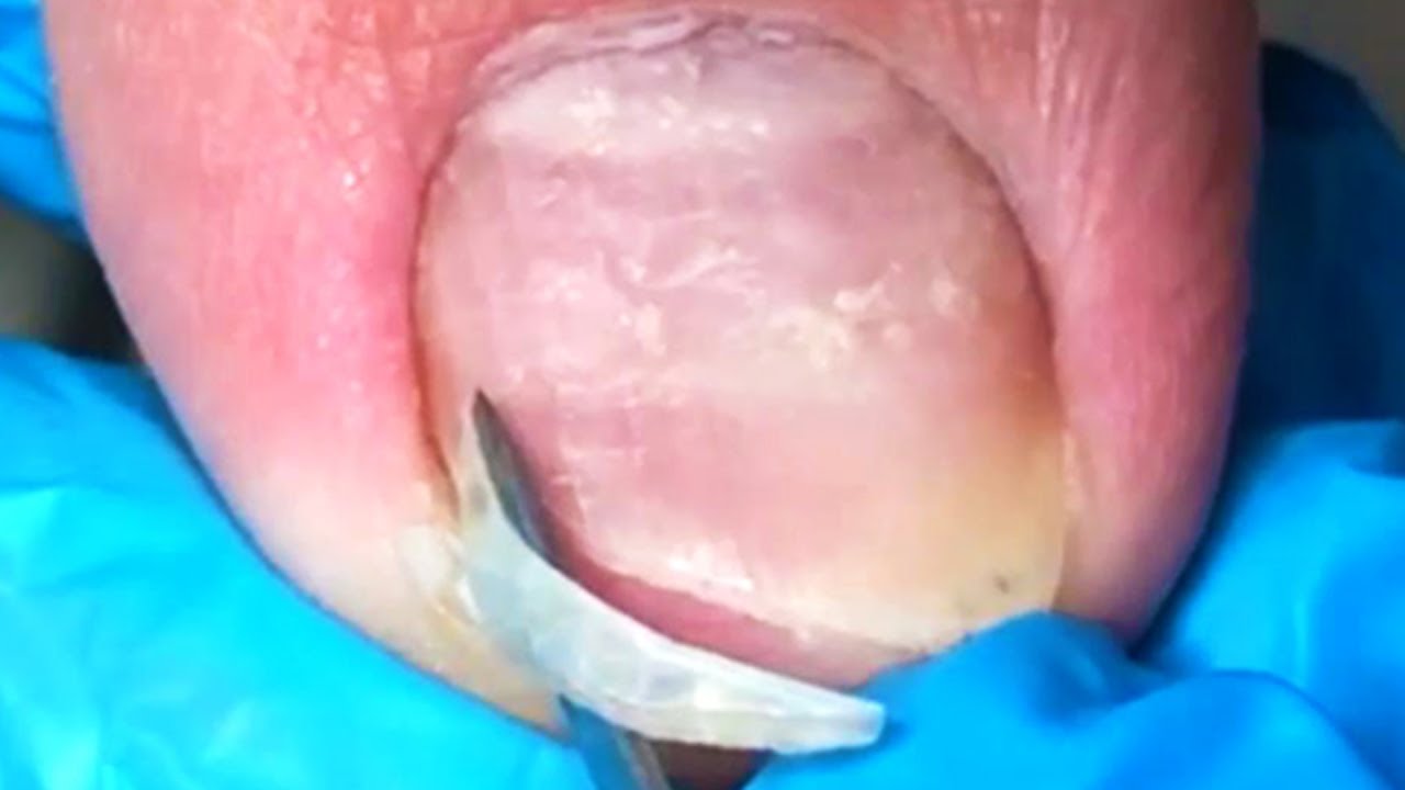 Carefully separate the ingrown toenail and dig it deep【Crazy pedicure ...