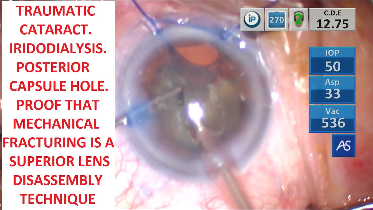Traumatic Cataract. Iridodialysis. PC Hole! Proof Mechanical Fracturing ...