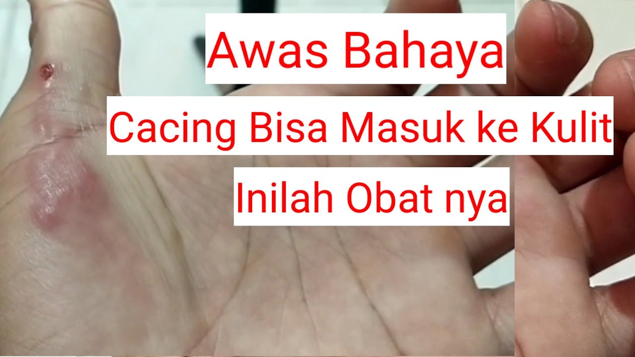 cacing masuk ke kulit, cutaneous larva migrans (CLM) dan inilah obatnya ...