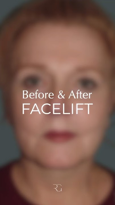 Ready for some outstanding facelift results? - YouTube