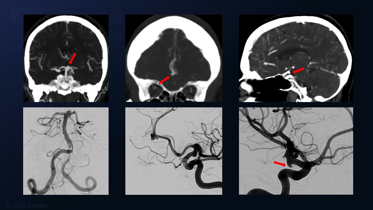 Orbitozygomatic Craniotomy for Clipping of Basilar Bifurcation Aneurysm ...