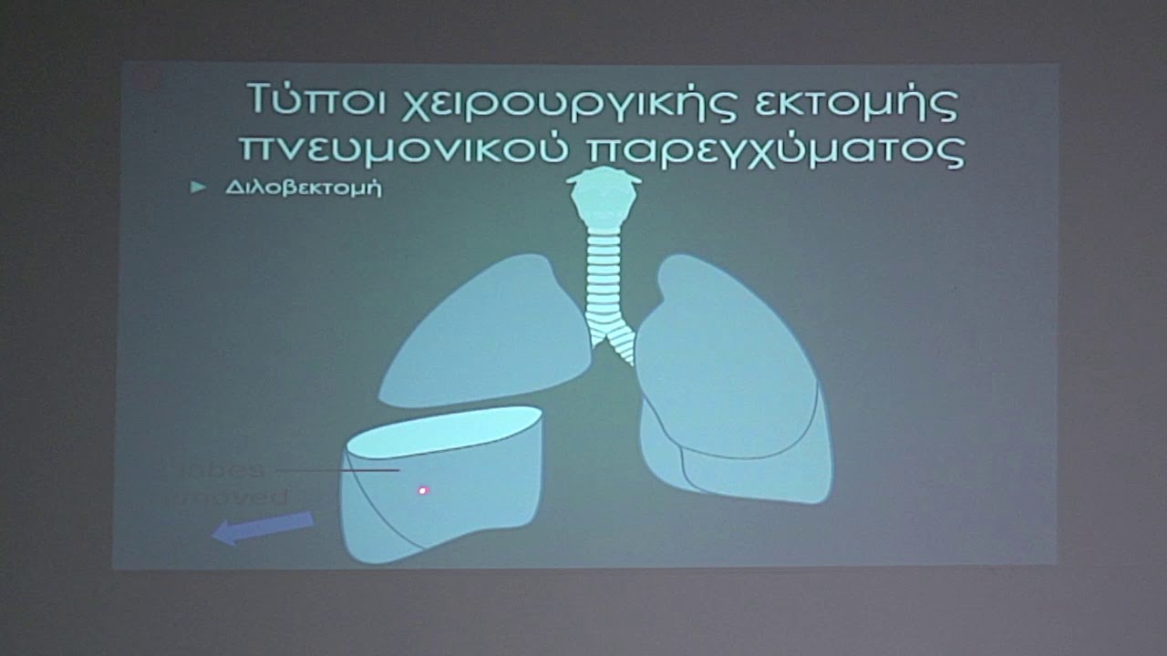 Χειρουργική αντιμετώπιση καρκίνου πνεύμονα σταδίου Ι & ΙΙ - Κ. Βάχλας ...