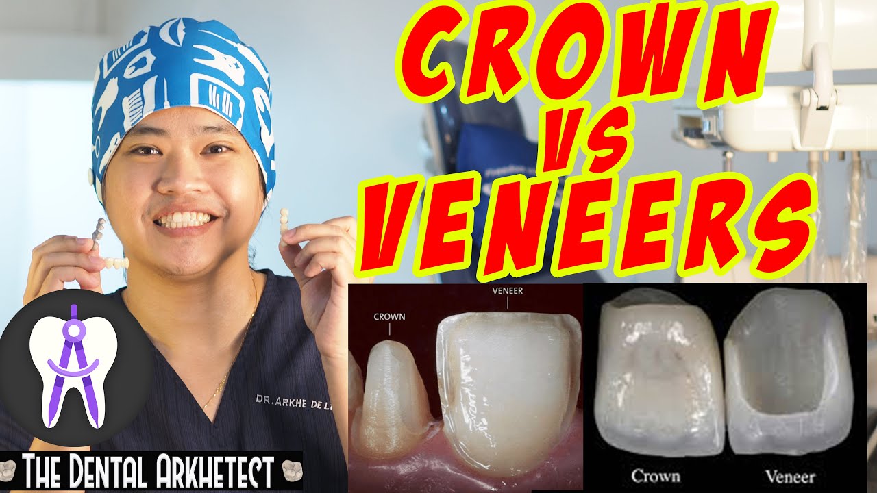 Kaibahan ng Dental Veneer at Crown (Jacket) #veneer #dentalcrown - YouTube