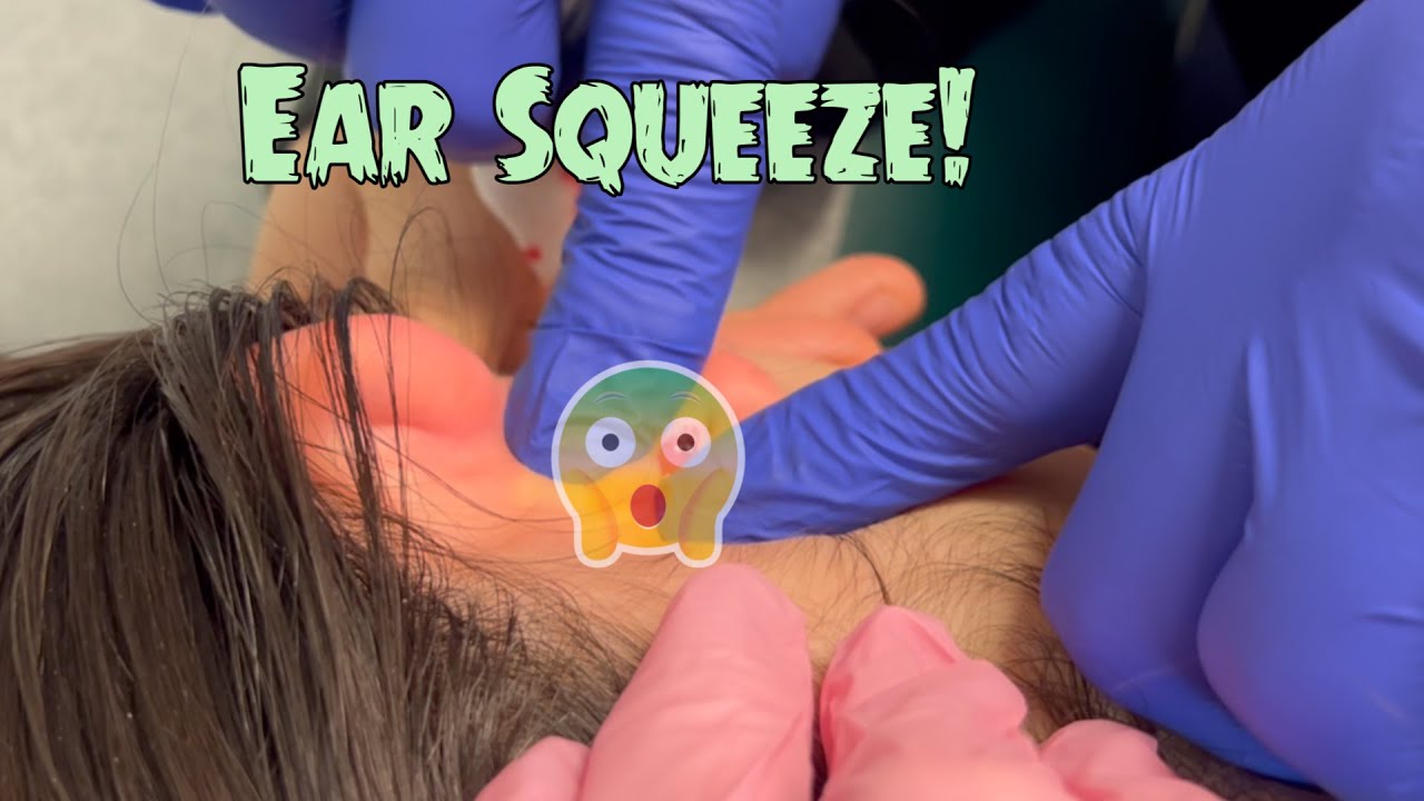 NEW! Oreo's Juicy Ear Pop - Big Bump Behind the Ear - YouTube