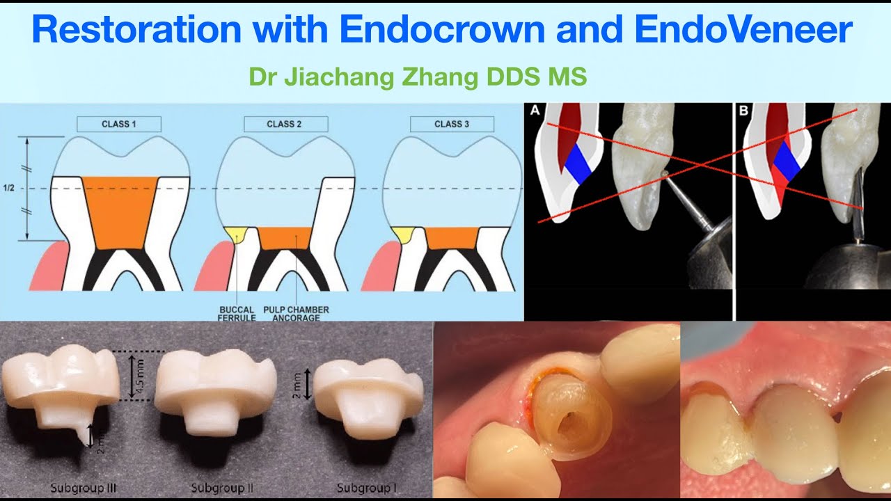 Restoration with EndoCrown and EndoVeneer - YouTube