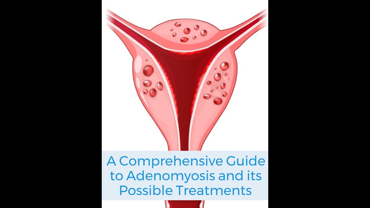 A Guide to Adenomyosis and Possible Treatments - YouTube