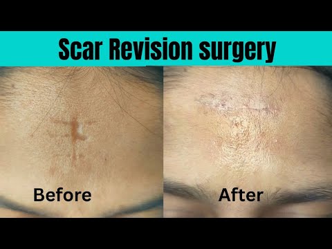 Scar revision surgery | Result of scar revision surgery| Forehead scar ...
