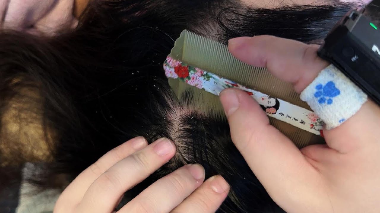 ASMR Ultimate Dandruff Scraping with Comb – No Talking - YouTube