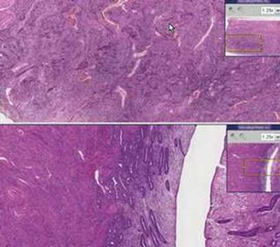 Histopathology Endometrium --Senile atrophy - YouTube