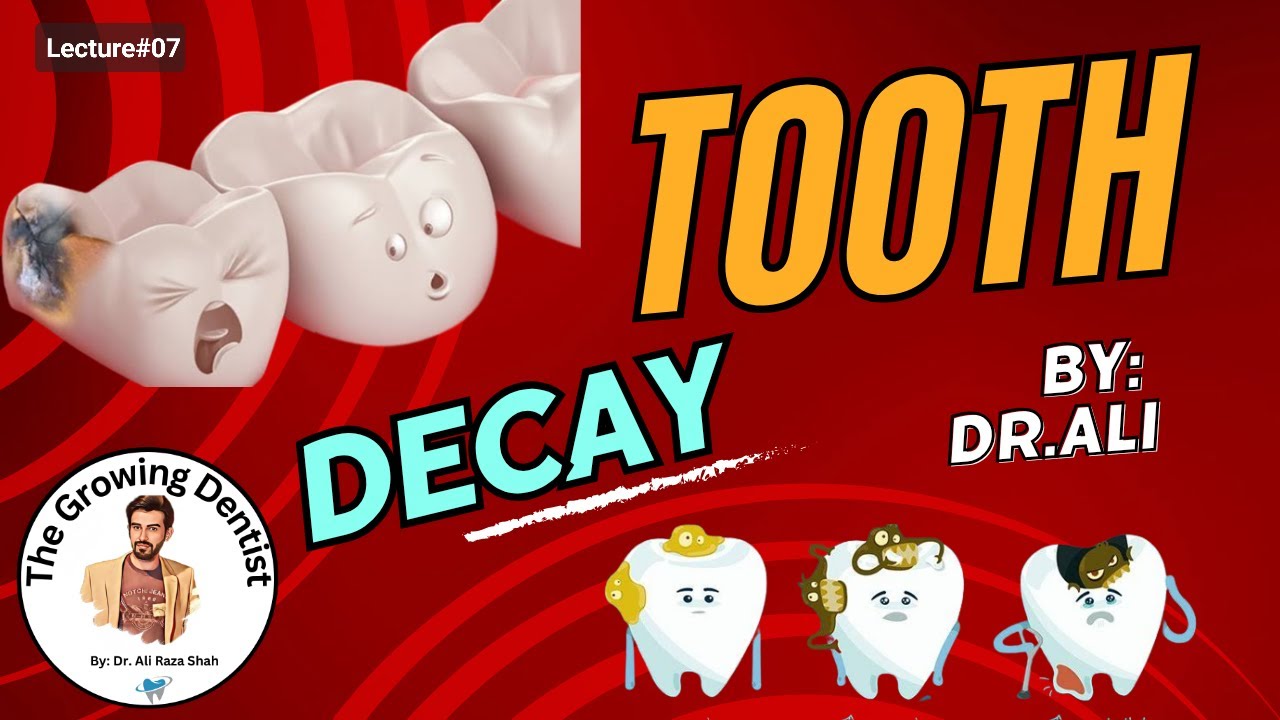 Dental Caries| Fight Tooth Decay| Teeth Cavities - YouTube
