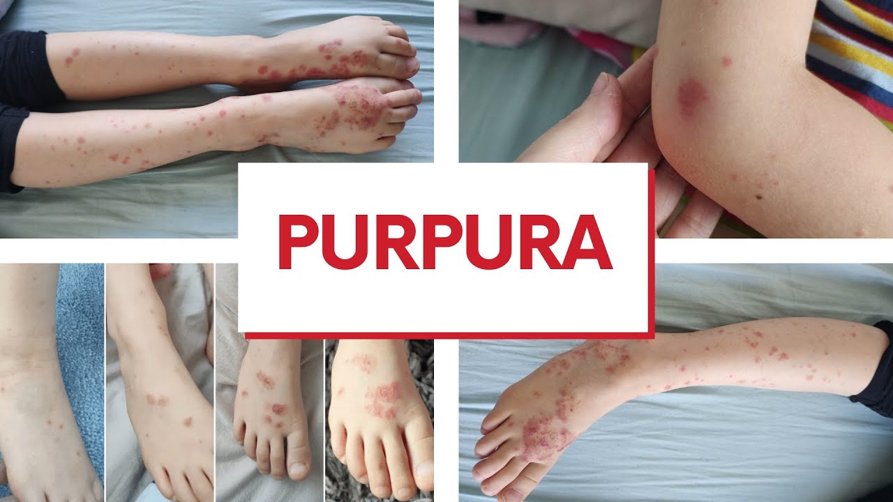 Henoch-Schönleinova purpura - nemoc, kterou moc lidí nezná... - YouTube