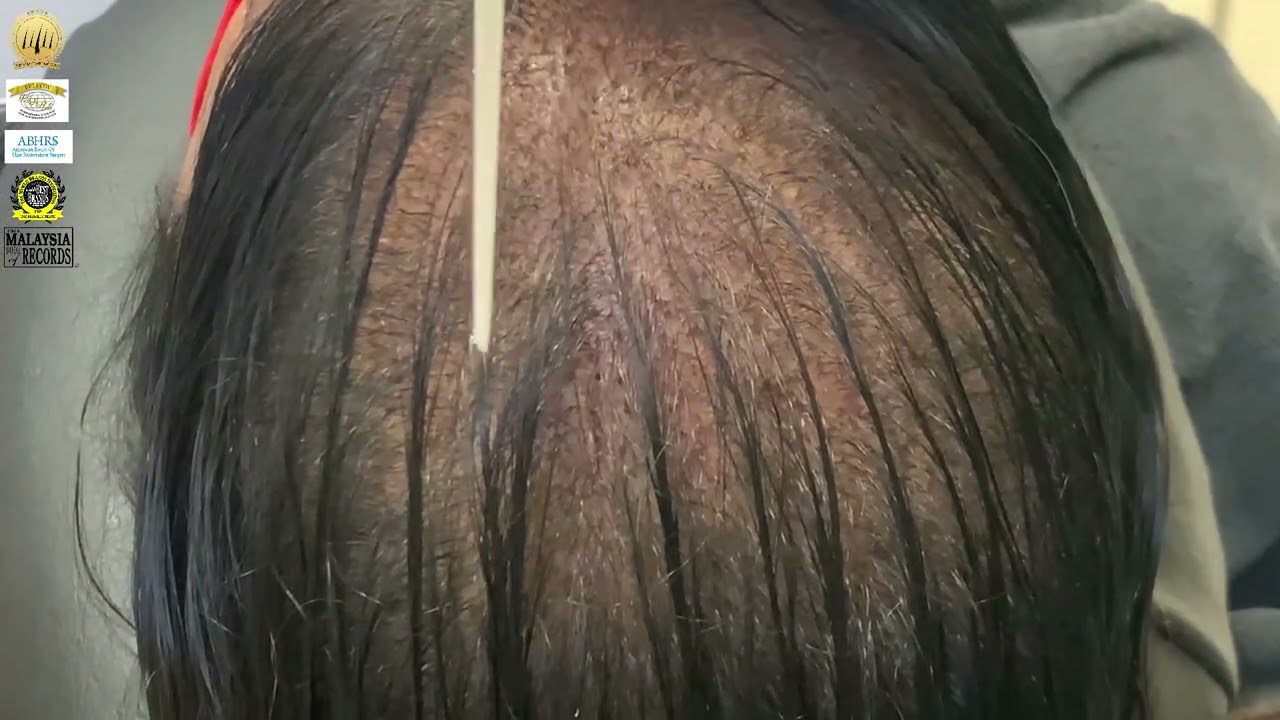 24 JAM SELEPAS TANAM RAMBUT ! FEMALE HAIR TRANSPLANT | SMART™ FUE HAIR ...