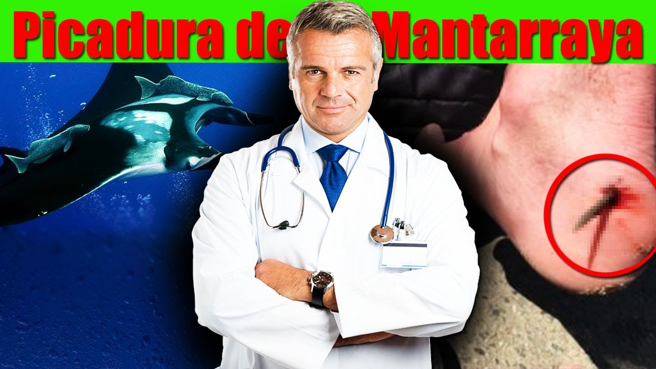 COMO TRATAR una PICADURA de MANTARRAYA - YouTube