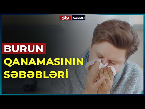 BURUN QANAMASININ SƏBƏBLƏRİ - STV XƏBƏRLƏR