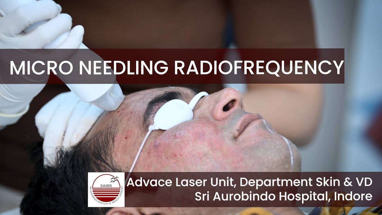 Micro Needling Radio Frequency | Laser Department | Sri Aurobindo ...