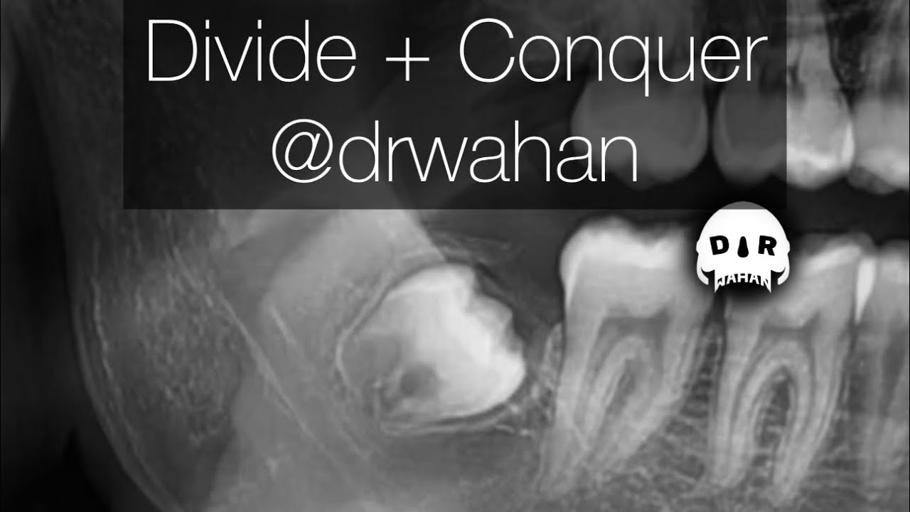 Sectioning a Wisdom Tooth and Using Purchase Points @drwahan - YouTube