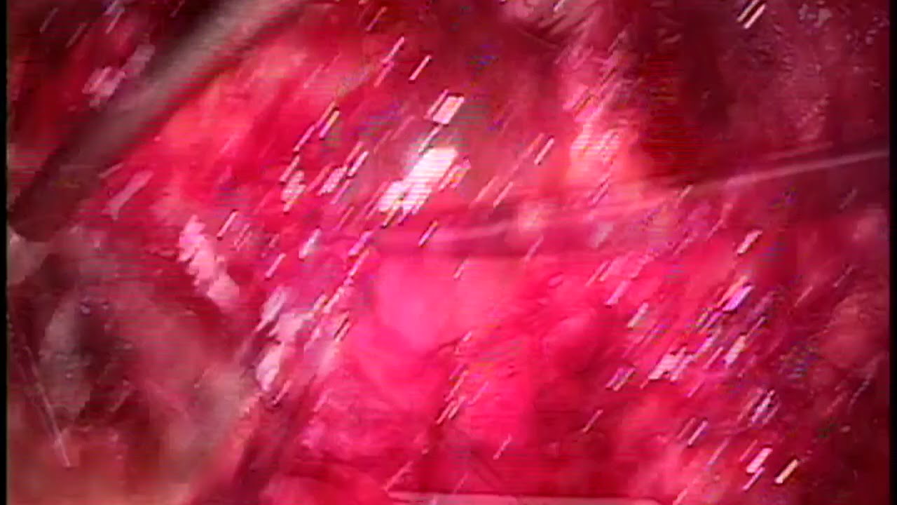 The Konno Procedure for a Redo Aortic Root Abscess - YouTube