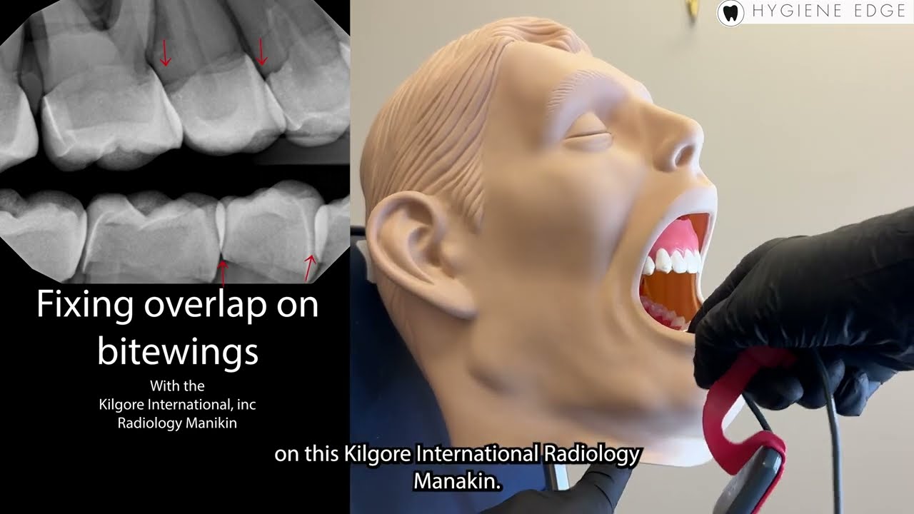 Fixing Overlap on Bitewings - YouTube