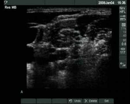 Ultrasound views of brachial plexus (interscalene) - YouTube