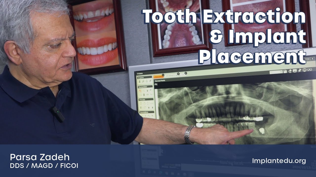 Same-Day Tooth Extraction & Implant: Step-by-Step (Final 4/4) - YouTube