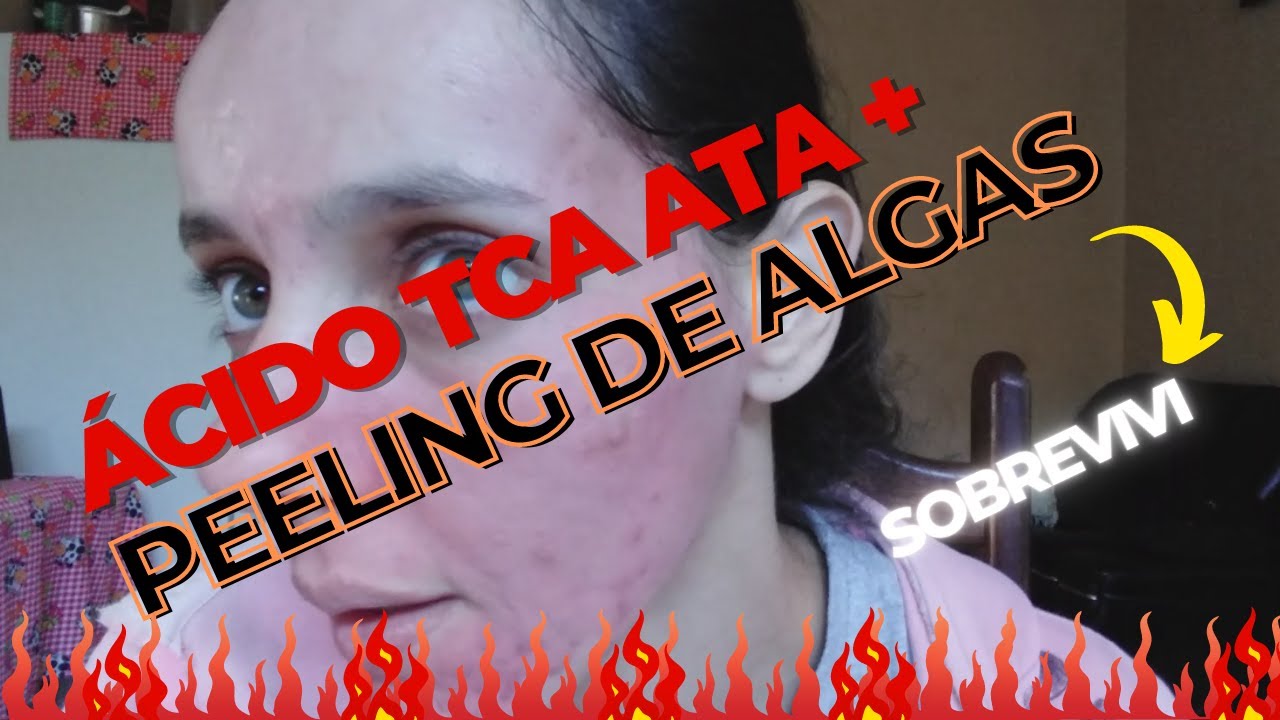 TCA ATA + PEELING DE ALGAS para tratamento de cicatrizes #cicatrizes # ...
