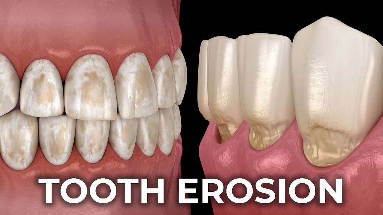 Tooth Erosion Explained: Causes, Symptoms & How to Save Your Smile! 🦷 ...