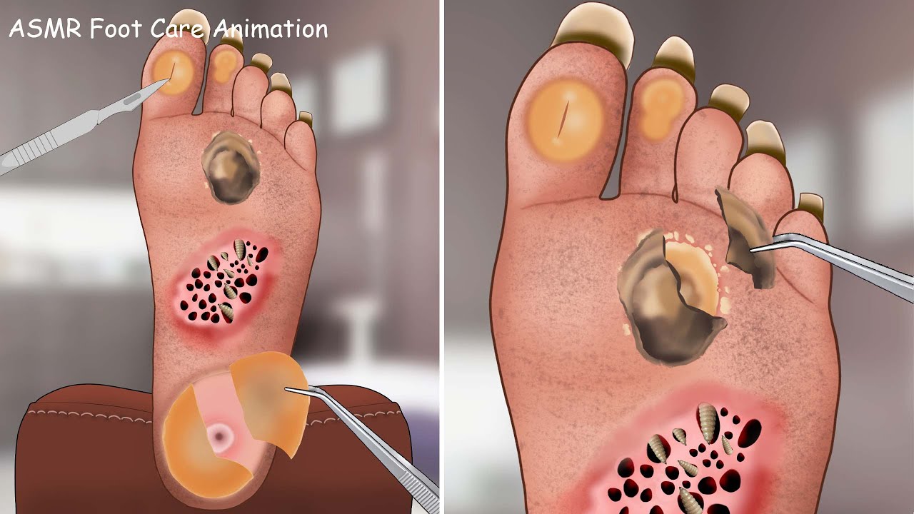 ASMR Satisfying Treatment injured foot | Remove Maggots,Calluses ...