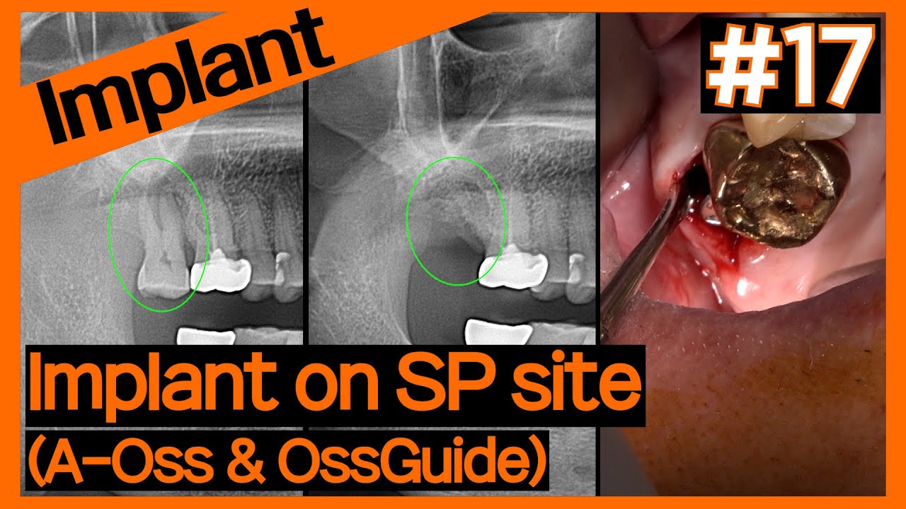 [Online Surgery] #17 Implant using OneGuide on socket preservationA Oss + OssGuide - YouTube
