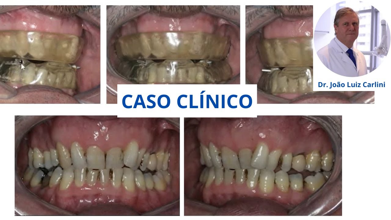 Ortognática Caso Clínico 04 - Dr. João Luiz Carlini - YouTube