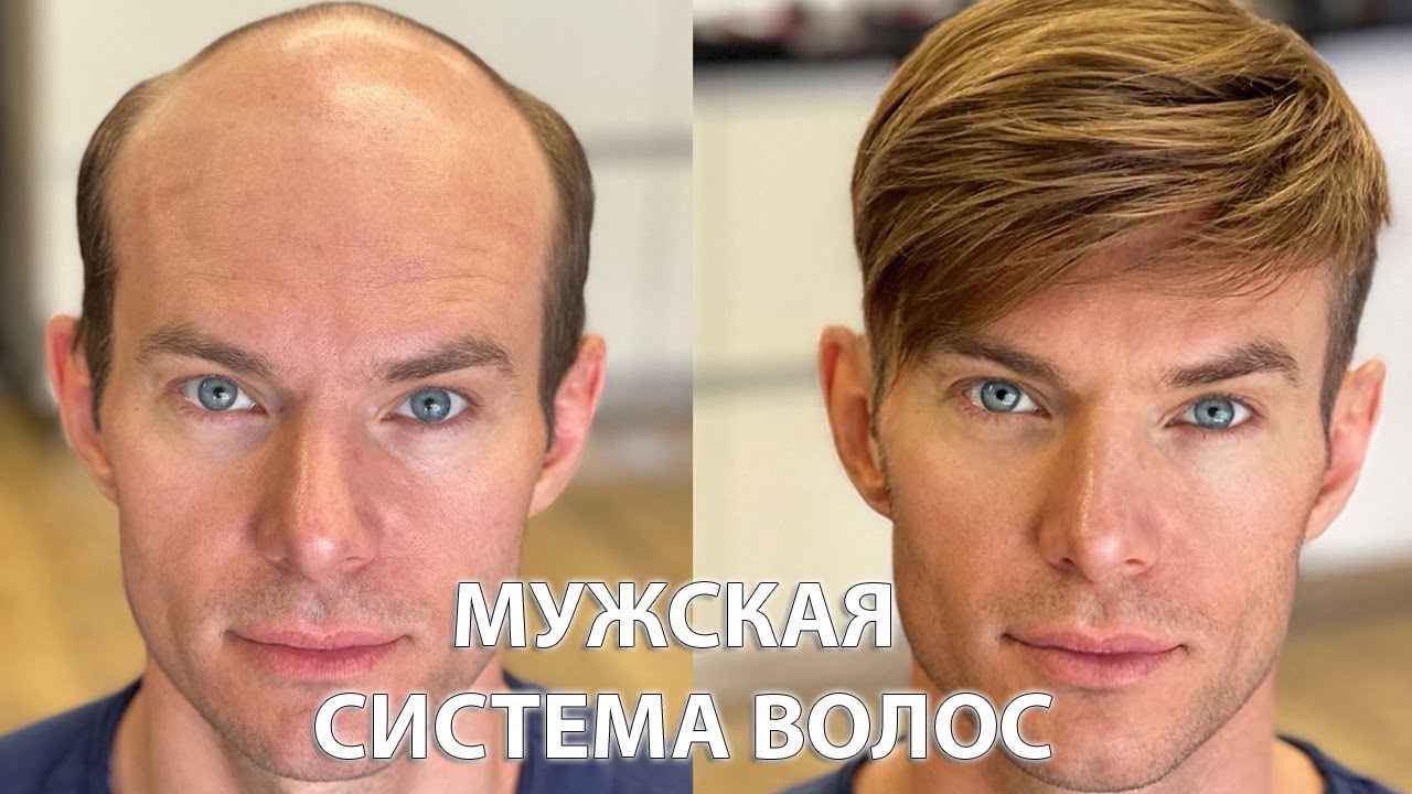 Алопеция у мужчин Накладка из волос До и после Youtube